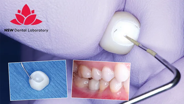 PFM Crowns Advantages And Disadvantages NSW Dental Lab PFM Crowns Advantages And Disadvantages NSW Dental Lab